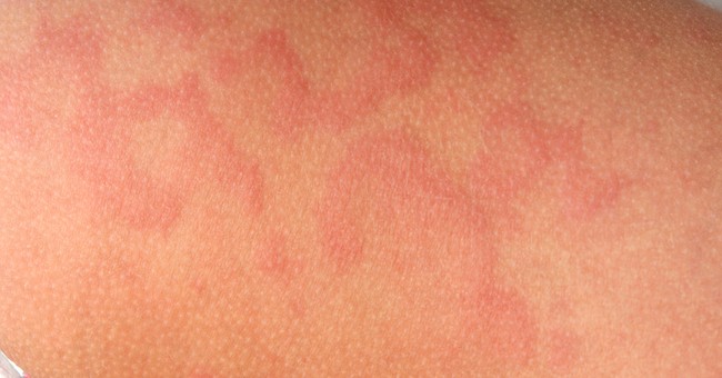Orticaria: cause, sintomi e rimedi naturali - GreenStyle
