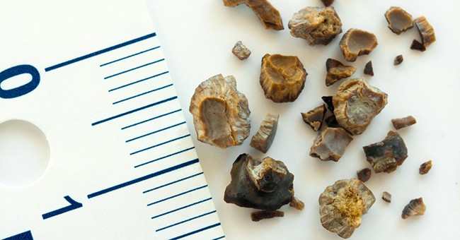 Calcoli renali: sintomi, cause e rimedi naturali - GreenStyle