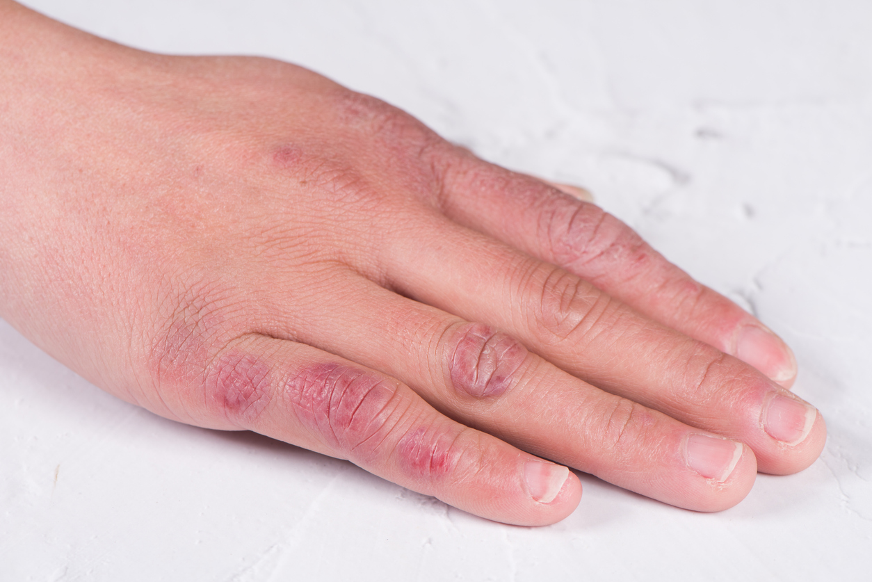 Geloni mani: i 5 rimedi della nonna più efficaci - GreenStyle
