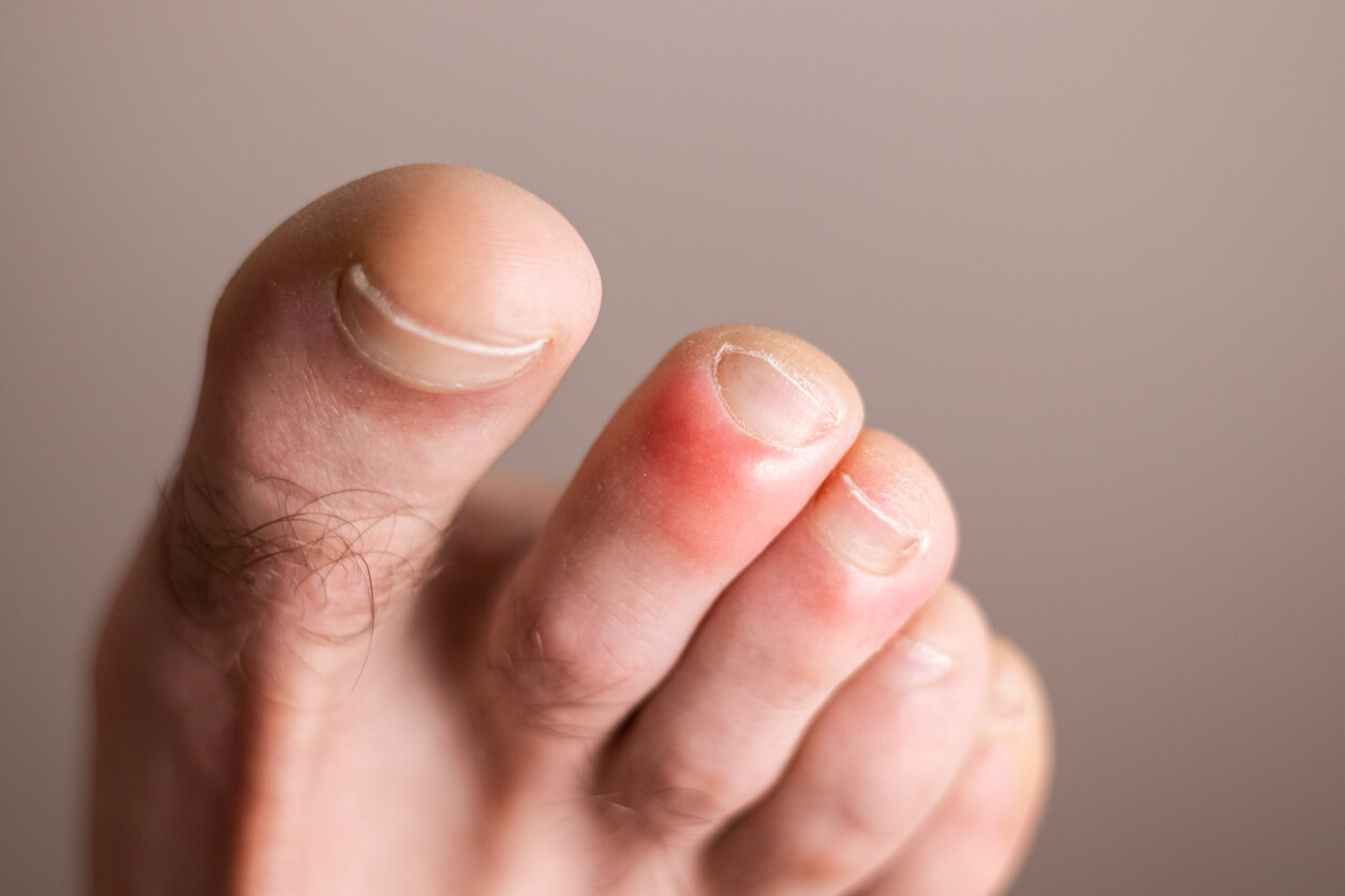 Come curare i geloni ai piedi con i rimedi naturali - GreenStyle
