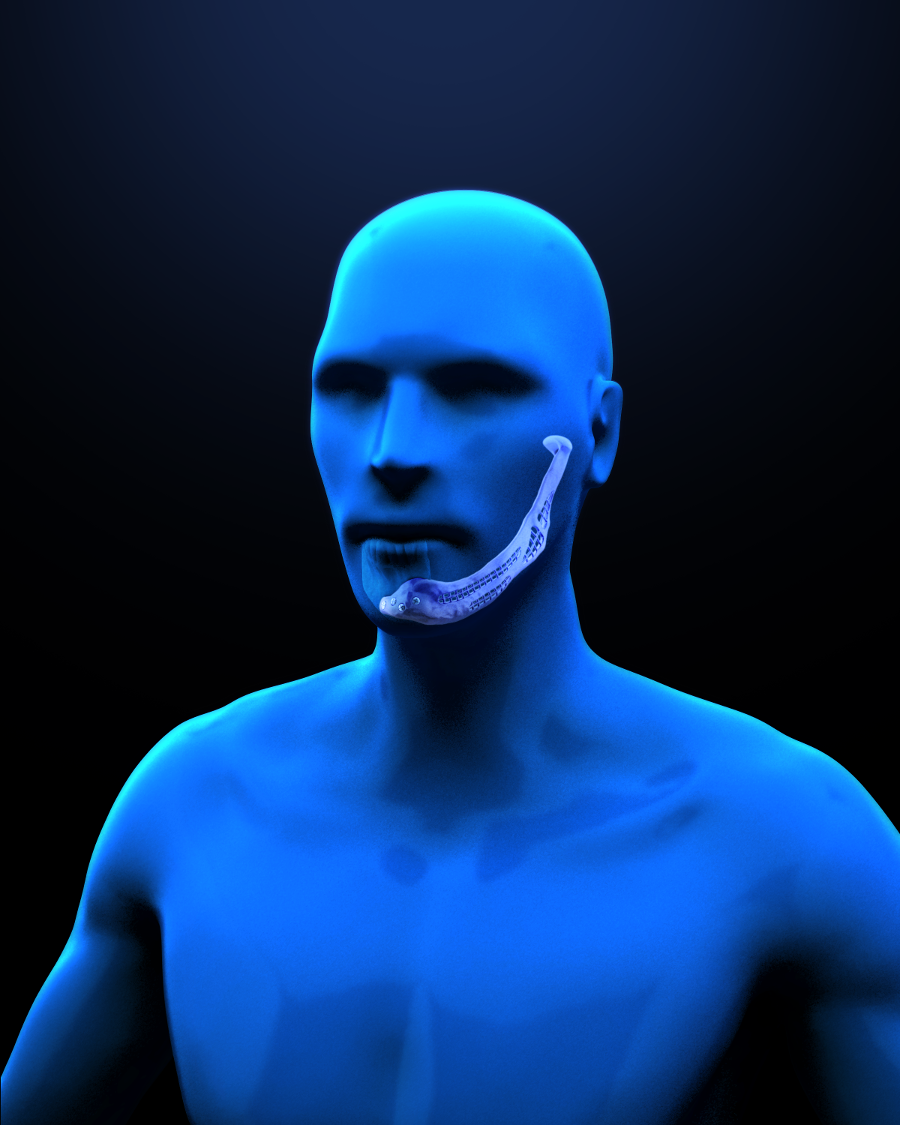 Italia, a Padova il primo trapianto di mandibola artificiale ...