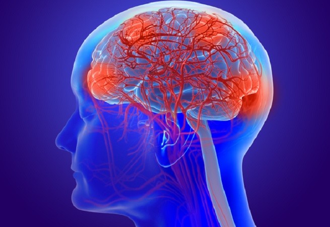 Giornata Mondiale dell'ictus cerebrale: come riconoscerlo - Benessereblog