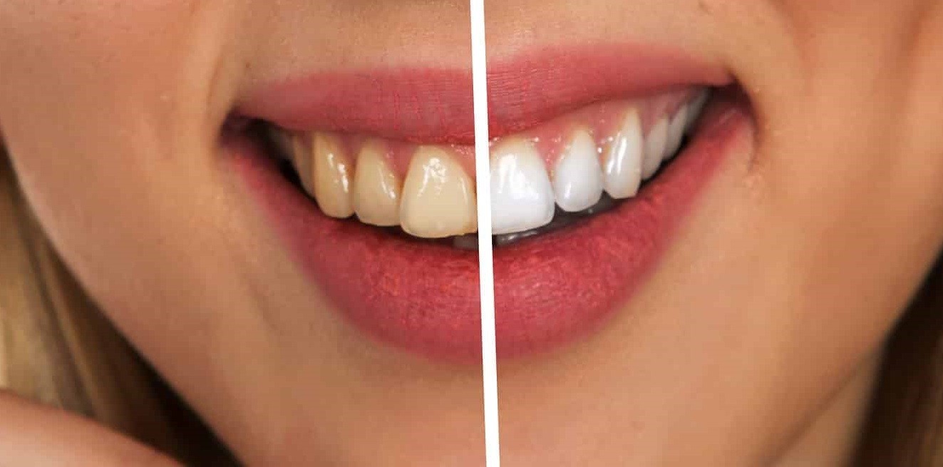 Come Sbiancare I Denti Benessereblog Come Sbiancare I Denti Benessereblog